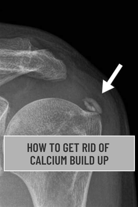 Calcium Build Up 7 Effective Ways To Get Rid Of Them In 2024 Calcium Deposits Calcium High
