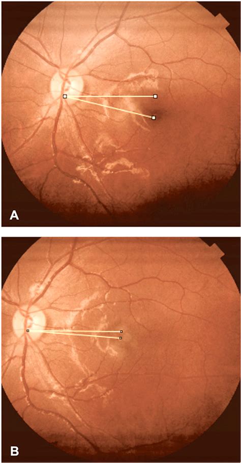 Novel Inferior Oblique Muscle Y Splitting Procedure To Minimize The An
