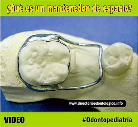 Ortodoncia ¿qué Es Un Mantenedor De Espacio Directorio Odontológico