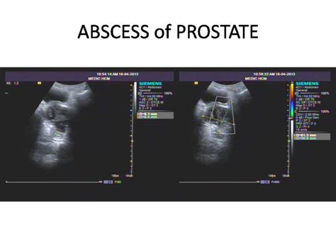 Absceso Prostático 2 Doccheck