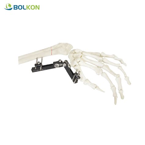 Bolkon Bone Fracture External Fixator Wrist Elbow Joint Tibial Femoral External Fixation China