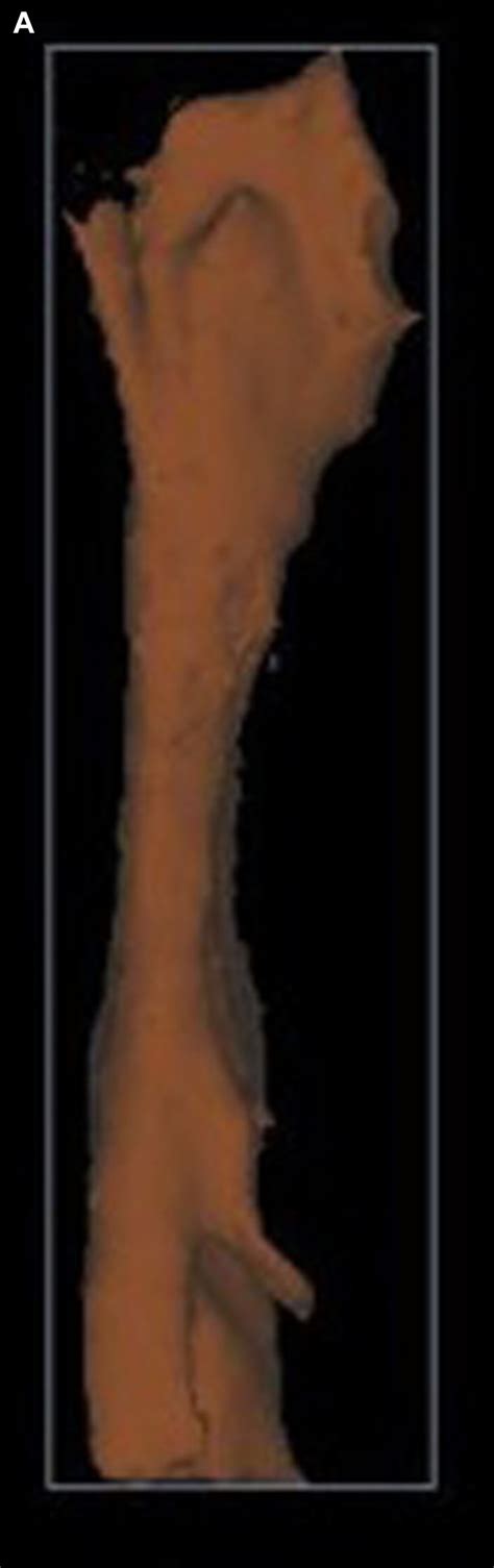 Three Dimensional Airway And Segmentation A The Total Airway Is