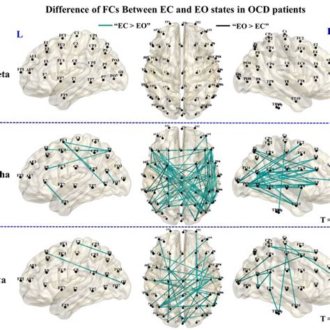 The Alteration Of Brain Functional Networks In Ocd Patients From Ec To Download Scientific