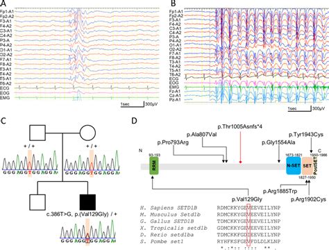 Eeg Findings And The Setd1b Variant In The Patient A Interictal Eeg
