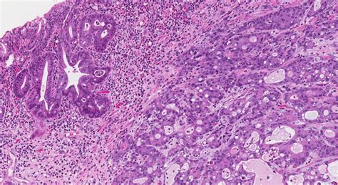 Barrett39s Esophagus And Adenocarcinoma Ppt Powerpoint