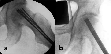 Intraoperative X Rays Of Core Decompression And Cancellous Bone Download Scientific Diagram