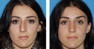 Deviated Septum Causes Symptoms Diagnosis Treatment Recovery And Overview Scope Heal