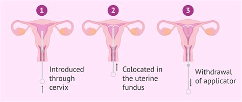 Iud In Cervix