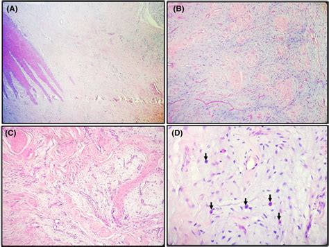 A Microscopically There Was A Poorly Circumscribed Subcutaneous Download Scientific Diagram