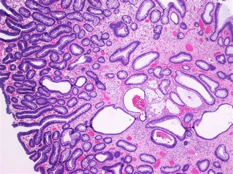 Juvenile Polyp