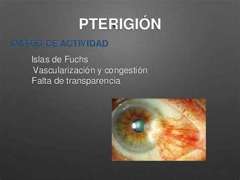 Pterigion