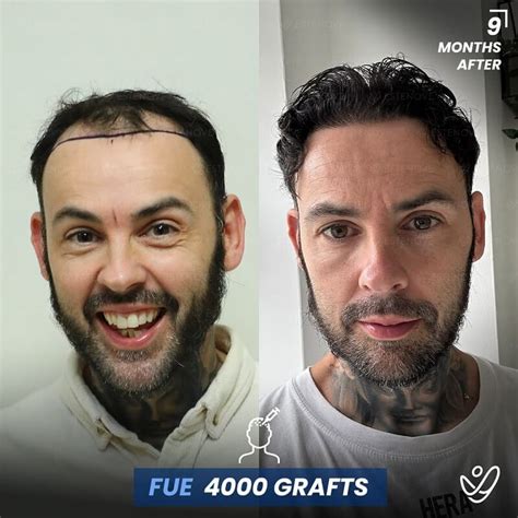 Dht And Hair Loss Causes Treatments And Solutions Estenove