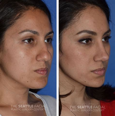 Bulbous Nose Rhinoplasty In Seattle Refine Your Nasal Tip