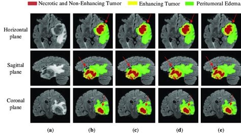 Segmentation Results Of The Ablation Experiment A Is The Modality Of Download Scientific