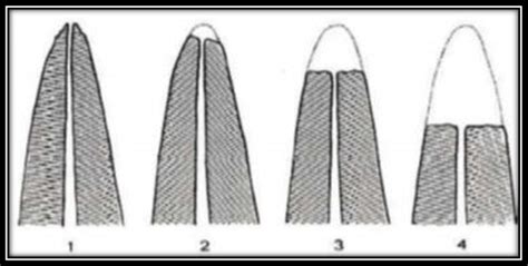 Schematic Illustration Of Lavender And Malmgren Classification For Earr