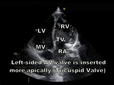Cc TGA How To Diagnose By Echocardiography YouTube