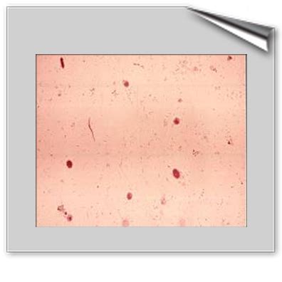 Leucociti E Eritrociti Urinari