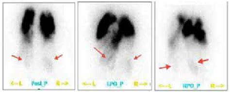 Perfusion Images Of V Q Scan Showing High Probability For Pulmonary Download Scientific Diagram