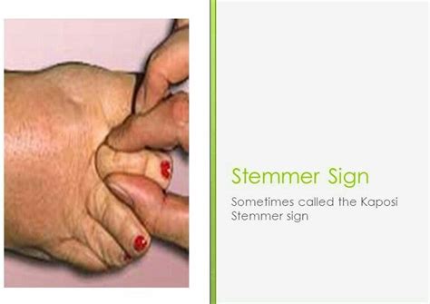 Stemmers Sign D T Lipoedema Leading To Subcutaneous Fibrosis Surgery