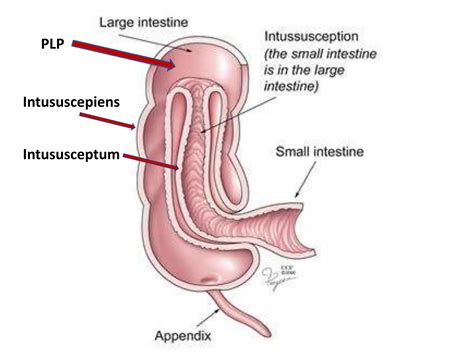 Pediatric Intussusception Pptx