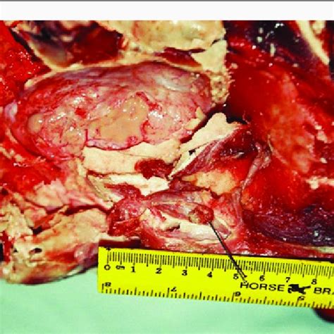 Onchocerca Nodules In The Subcutaneous Tissues Of A 7 Year Old