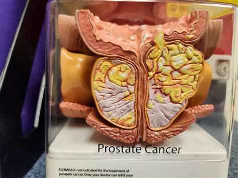 Magnetic Resonance Imaging In Prostate Cancer Screening Dovemed