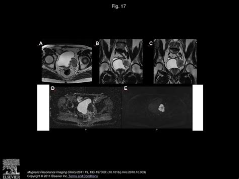 Pelvic Applications Of Diffusion Magnetic Resonance Images Ppt Download