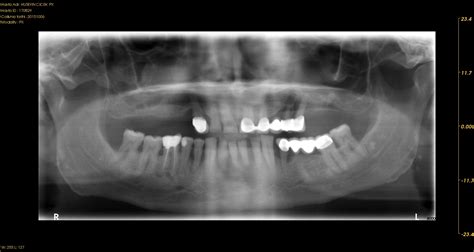 Lezyondetection Object Detection Dataset And Pre Trained Model By Serkan Yldz