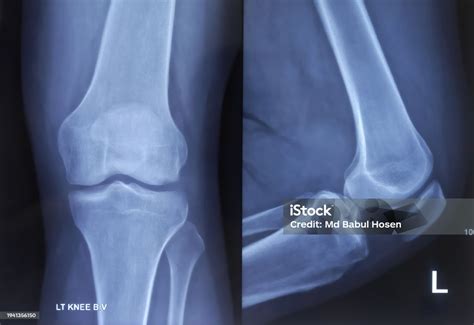 Xray Of Knee Joint Ap And Lateral View Small Fracture Fragmentpossibly