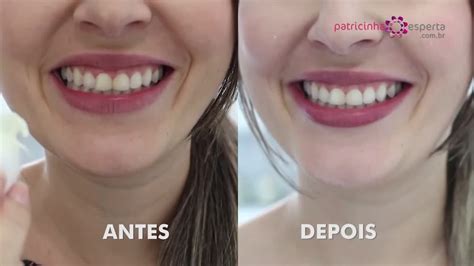 Clareamento Caseiro Antes E Depois Kpop 2ne1 Fandom