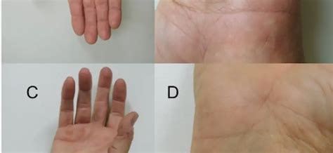 Тромбожуулсан хялгасан судас бүхий хялгасан судасны аневризм Миний