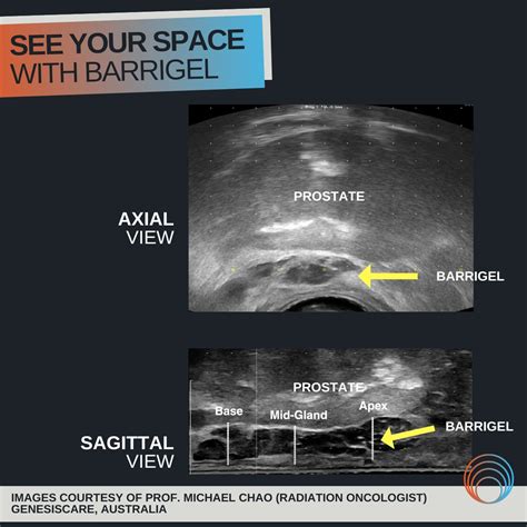 Barrigel On Linkedin Barrigel Prostatecancer Rectalspacer
