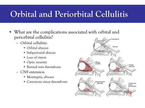Ppt Facial Soft Tissue Infections Powerpoint Presentation Free