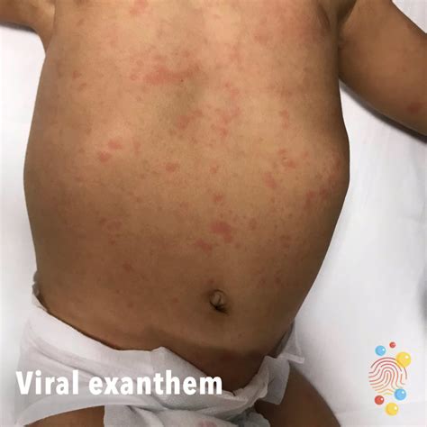 Viral Exanthem