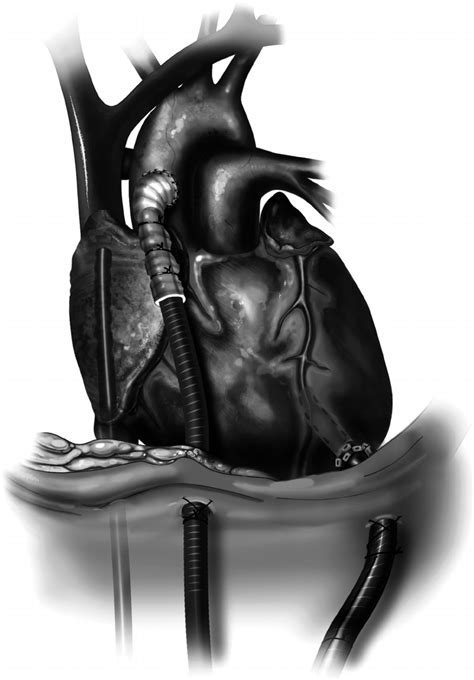 Va Ecmo Lv Venting Paul Smith