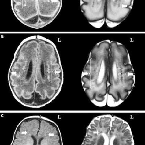 Overview Of Punctate Lesions Results Are Grouped According To The