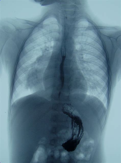 Esophagography Excluded The Possibility Of Esophageal Stenosis