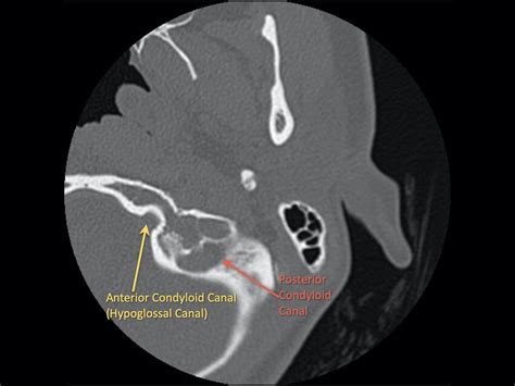 Normal Temporal Bone Ct With Annotated Images Radiopaedia 84293 99584 Axial Annotated Nc Commons