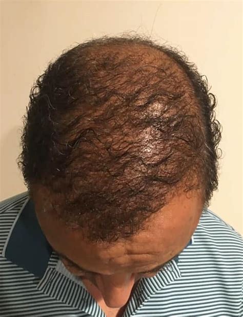 Does Minoxidil Work For Hair Loss Best Hair Transplant