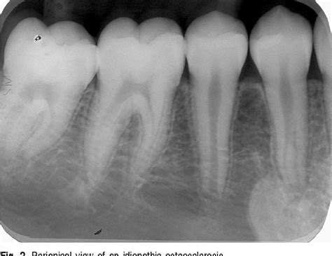 Condensing Osteitis Jaw At Taylah North Blog