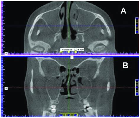 Maxillary Sinuses Visualized As Dark Low Density Areas A Axial