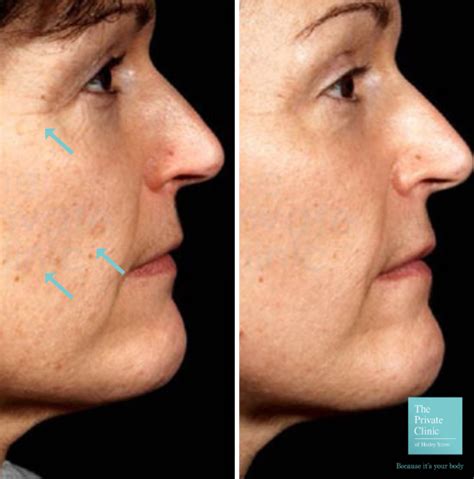 Laser Skin Treatments Pearl And Pixel Laser Skin Resurfacing Treatments