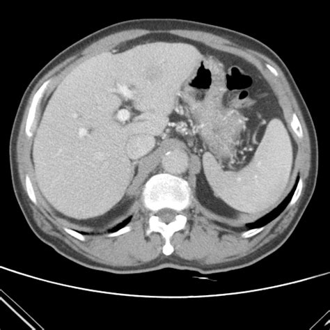 Automatic Liver And Tumor Segmentation Using Cdnn And Ahcnet With Download Scientific Diagram