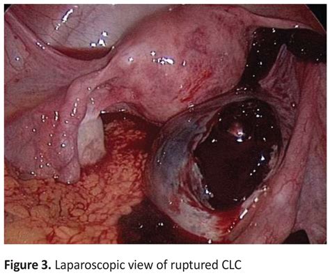 Ruptured Ovarian Cyst Discharge