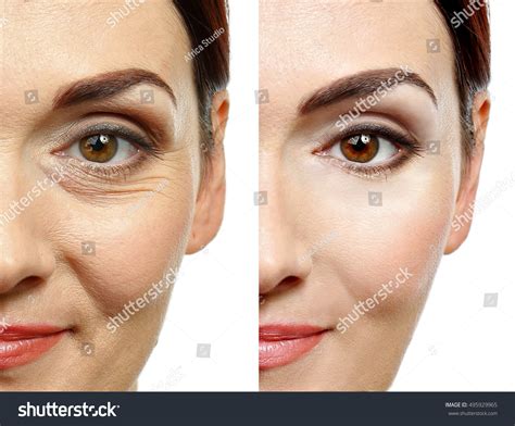Woman Face Before After Cosmetic Procedure Stock Photo Shutterstock