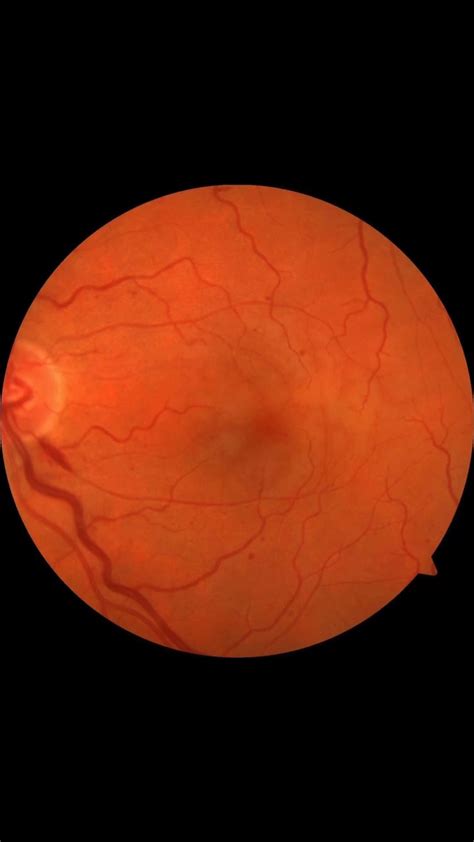 Optometrist And Ophthalmologist 👀 Retina Review 65 Year Old Hypertensive Woman With Ruptured