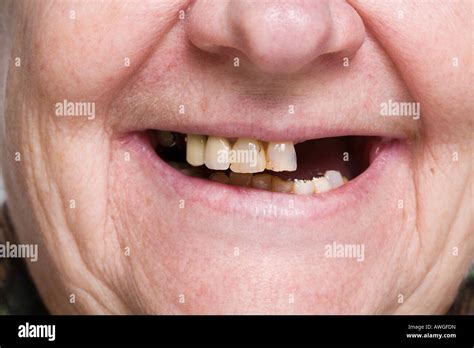 Missing Teeth Woman