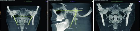 Elongated Styloid Process A Mediolateral Angulation B