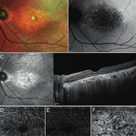 Multimodal Retinal Imaging In Prph2 Gene Related Pattern Dystrophy