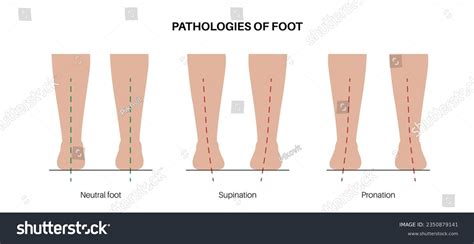 What Is Pronation In Anatomy Круглый пронатор лат